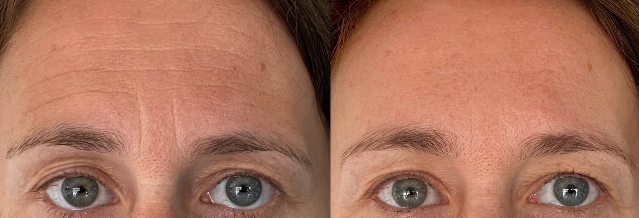 Quels sont les effets secondaires du botox ? l Dr KOPPE