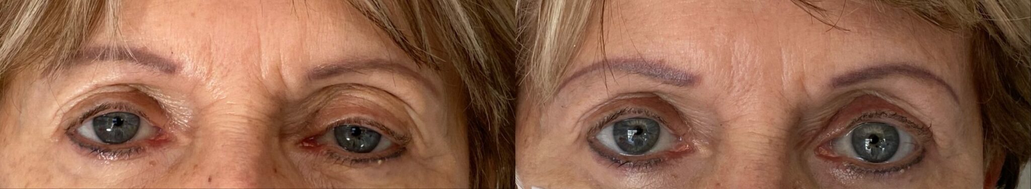 Ptôse Palpébrale (ptosis) : Comment la Reconnaître ? - Dr Koppe